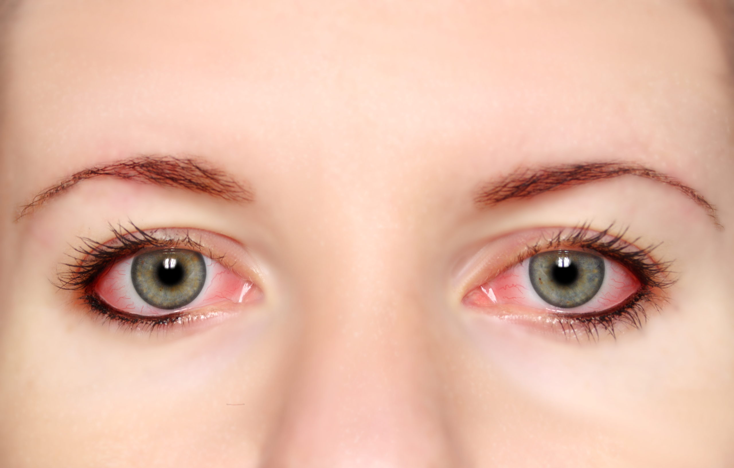 Sintomas, causas e tratamentos para Conjuntivite - Blog Hospital Pilar