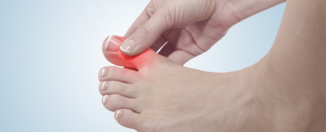 Gota (doença) - Blog Hospital Pilar